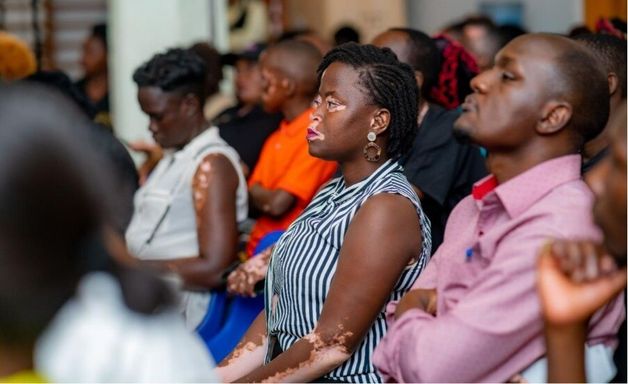 Embracing Diversity: Addressing Stigma Against Vitiligo in Uganda ...